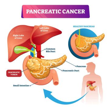 Ozempic, Wegovy, Other Glp-1ra Drugs Not Linked To Increased Pancreatic ...